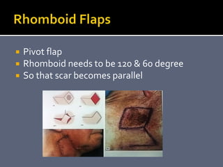 Local flaps in ent | PPTX