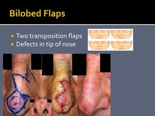 Local flaps in ent | PPTX