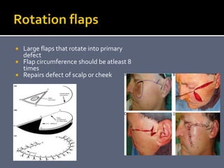 Local flaps in ent | PPTX