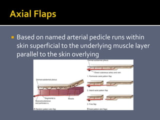 Local flaps in ent | PPTX