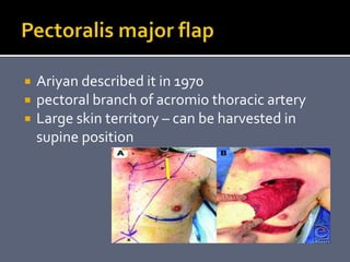 Local flaps in ent | PPTX