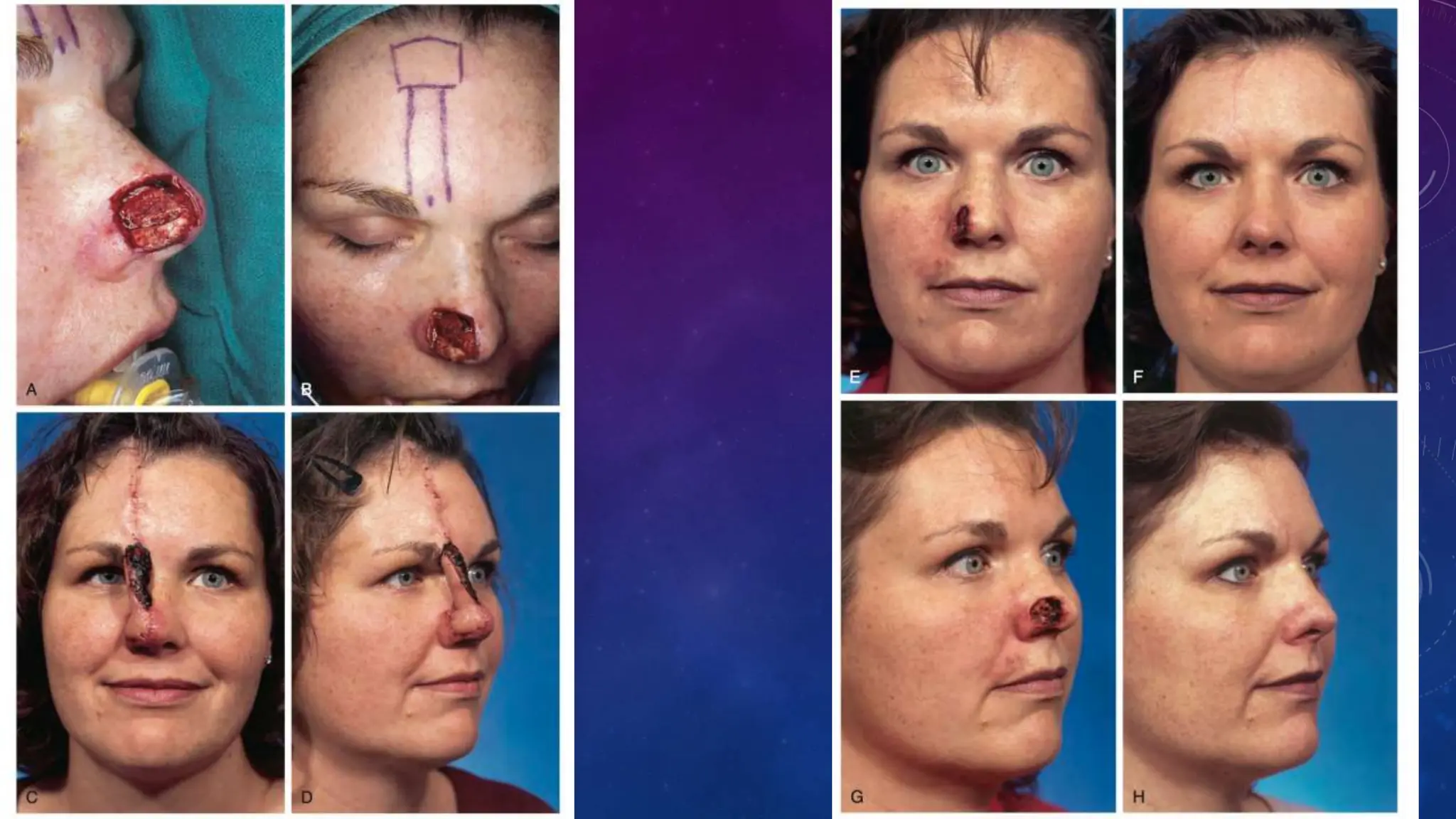 local flaps in head and neck surgery -Maroti.pptx