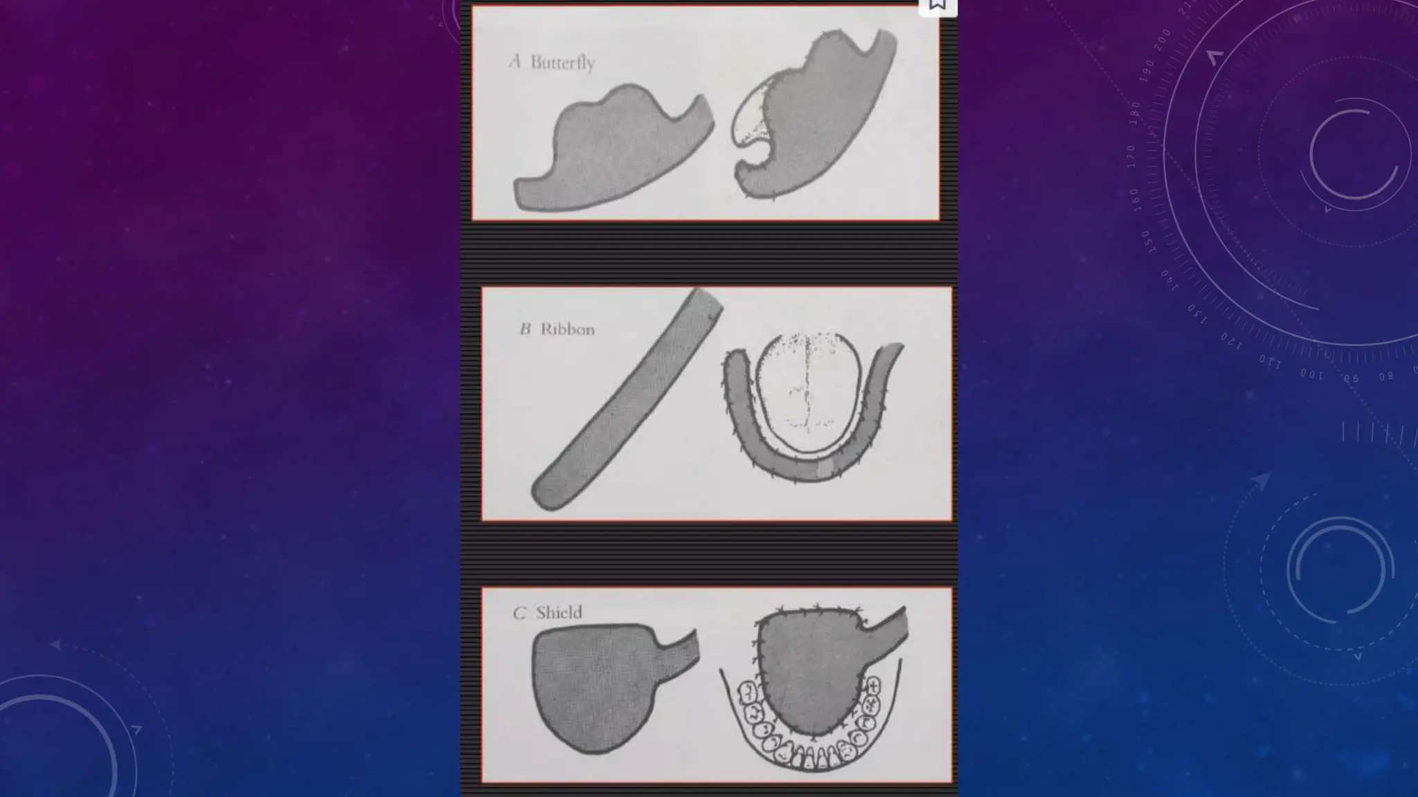 local flaps in head and neck surgery -Maroti.pptx