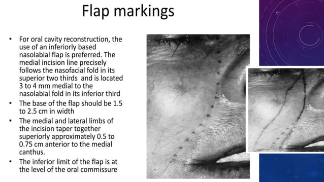 local flaps in head and neck surgery -Maroti.pptx