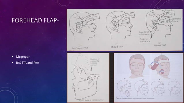 local flaps in head and neck surgery -Maroti.pptx