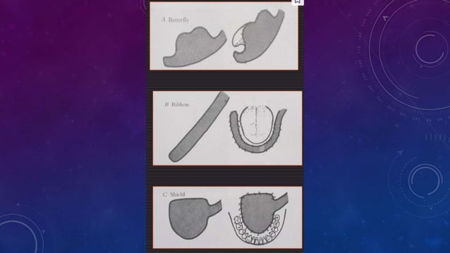 local flaps in head and neck surgery -Maroti.pptx