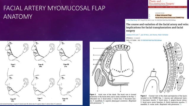local flaps in head and neck surgery -Maroti.pptx