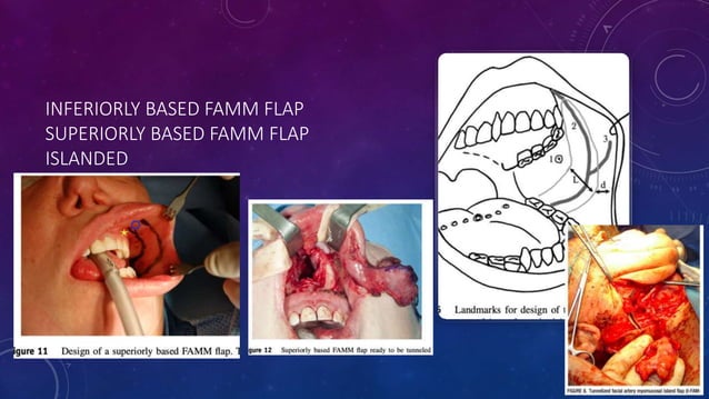 local flaps in head and neck surgery -Maroti.pptx