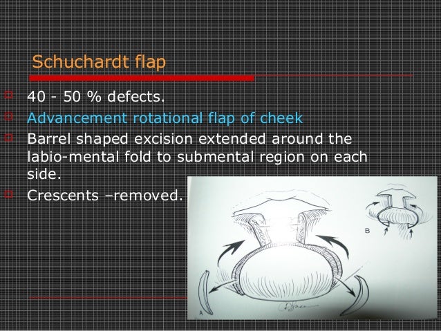 Local flaps seminar