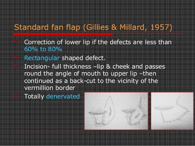 Gillies Fan Flap