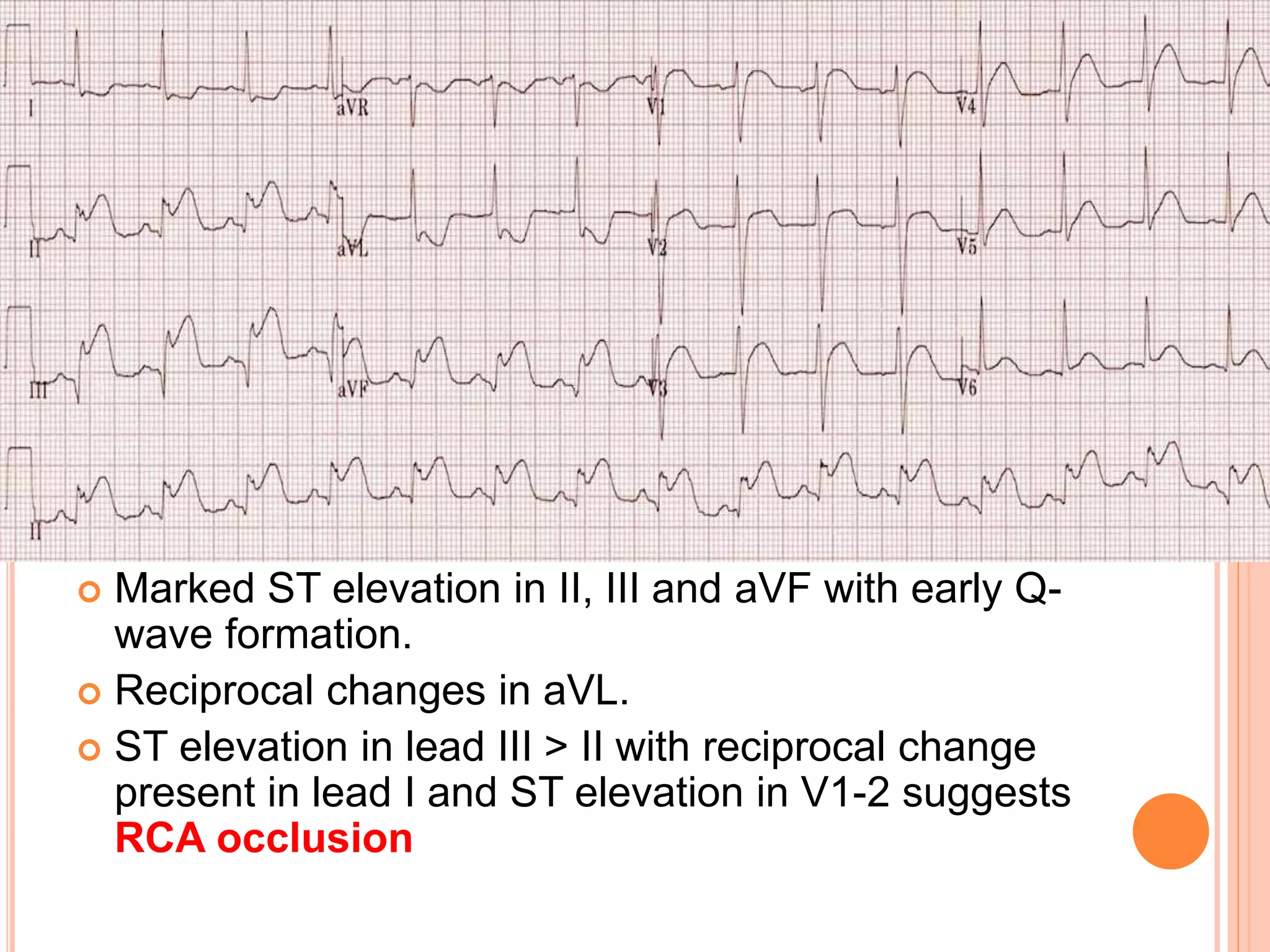 Localisation of Myocardial Infarction | PPTX
