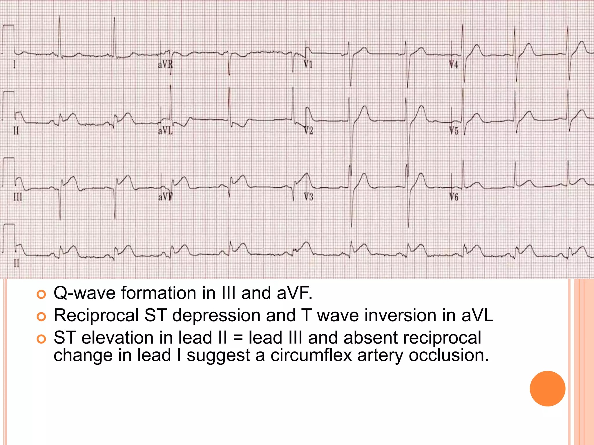 Localisation of Myocardial Infarction | PPTX