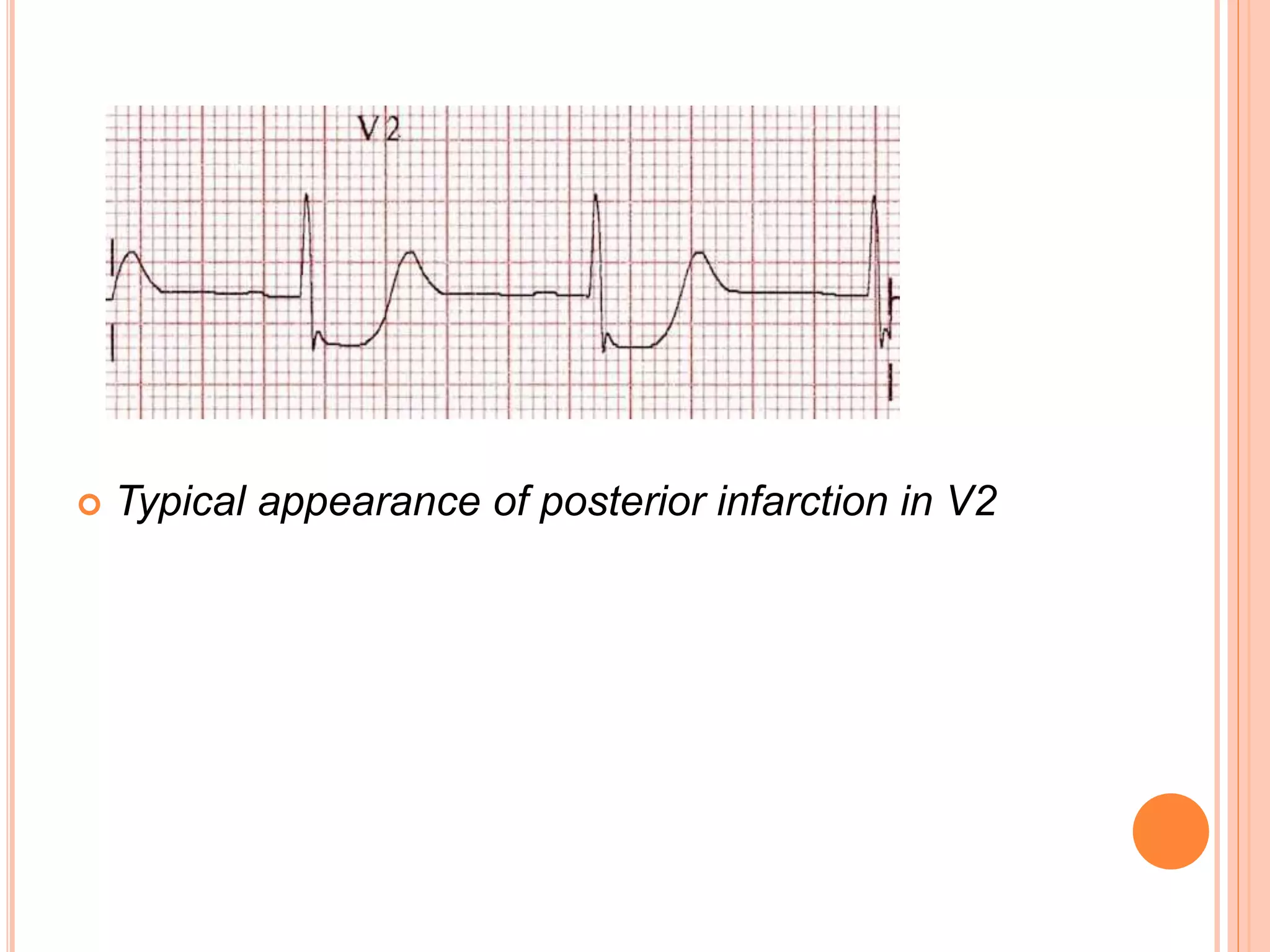 Localisation of Myocardial Infarction | PPTX