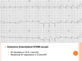 Localisation of Myocardial Infarction | PPTX