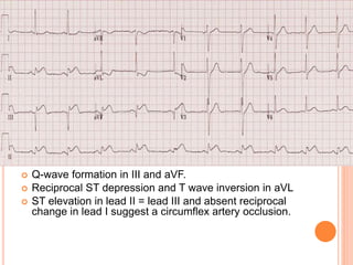Localisation of Myocardial Infarction | PPTX