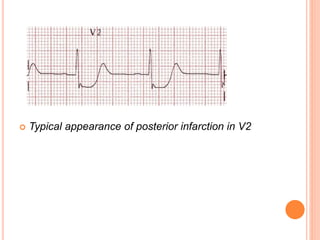 Localisation of Myocardial Infarction | PPTX
