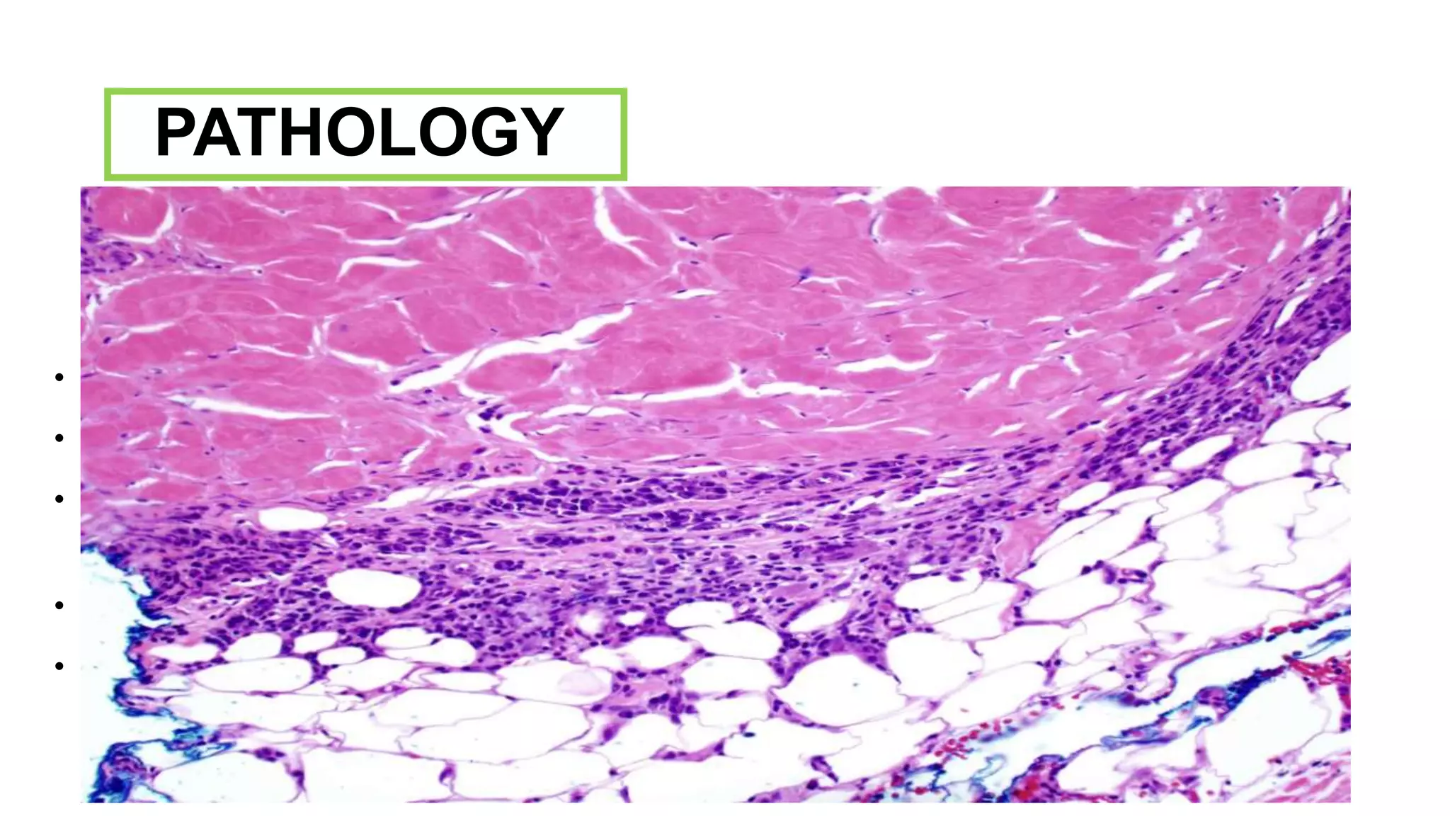 LOCALISED SCLERODERMA.pptx