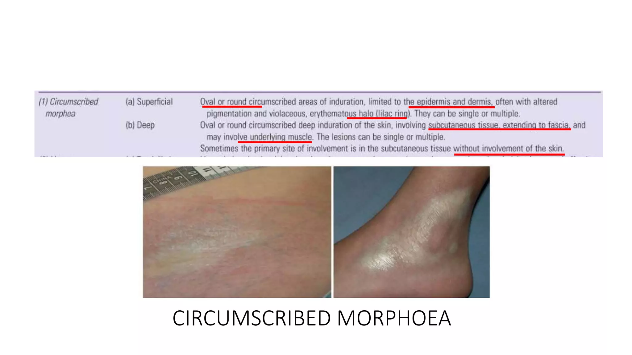 LOCALISED SCLERODERMA.pptx