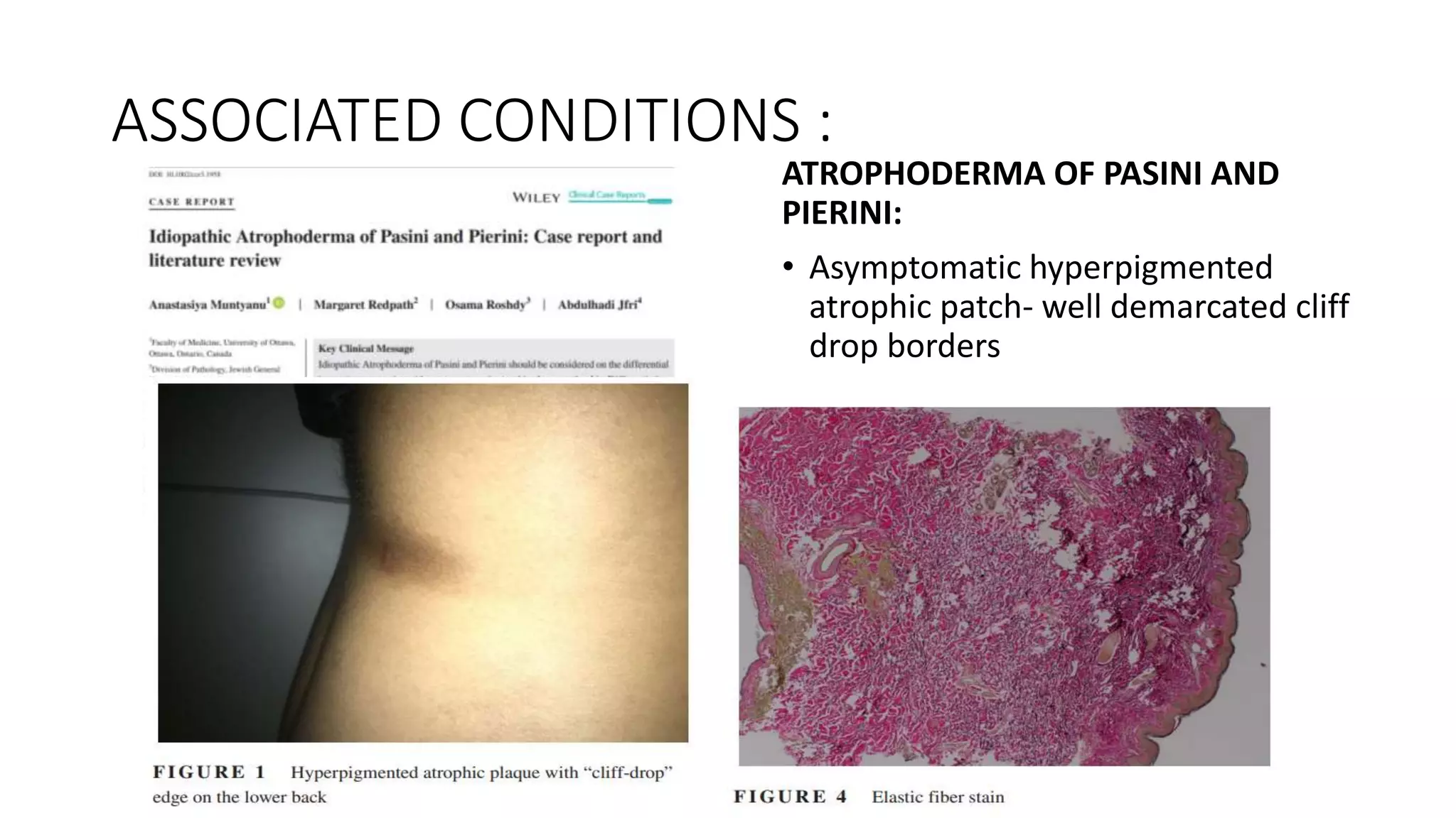 Localised Scleroderma Pptx
