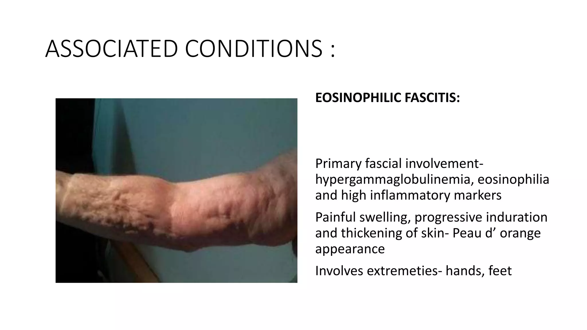 LOCALISED SCLERODERMA.pptx