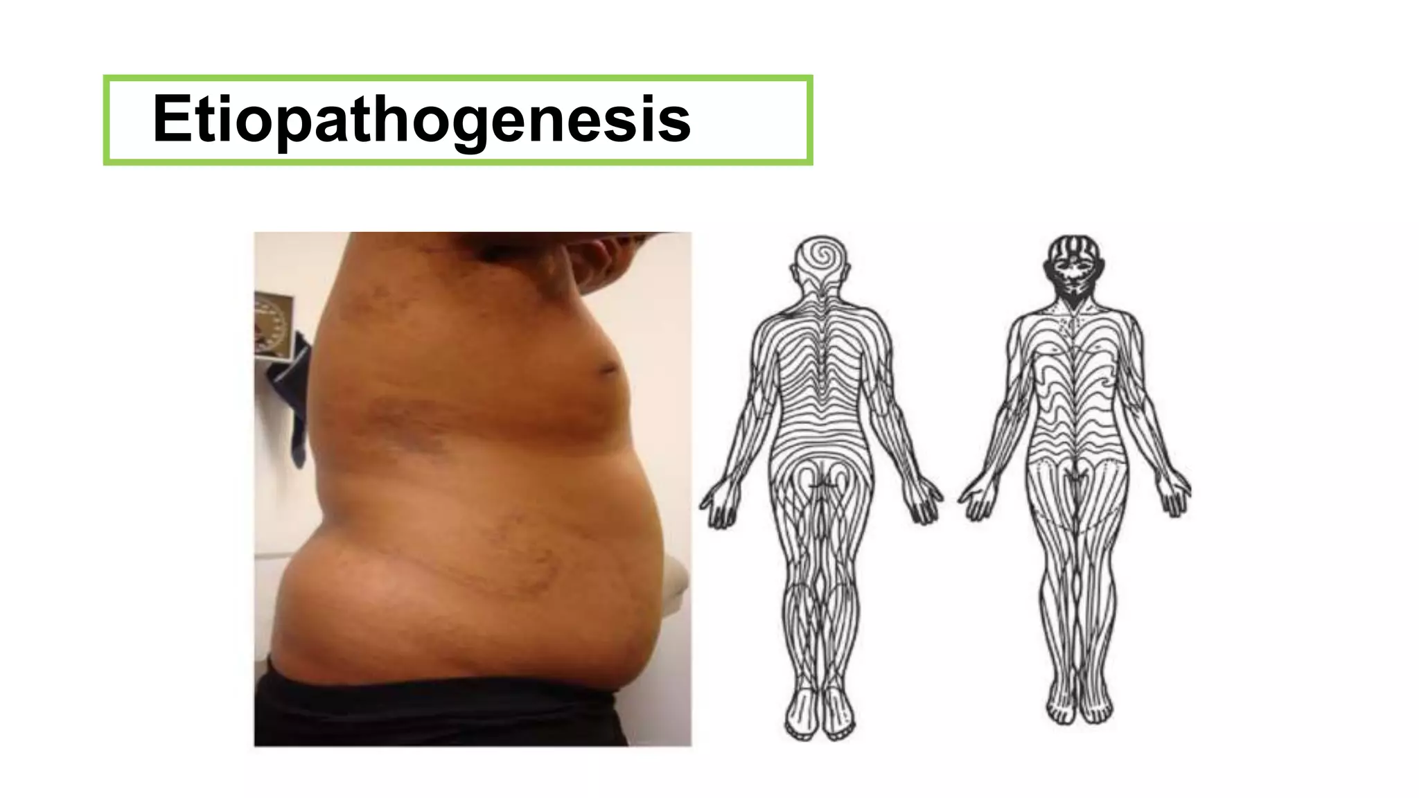 LOCALISED SCLERODERMA.pptx