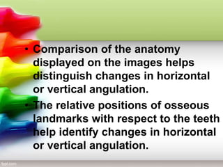 object Localization in intraoral radiographies | PPTX