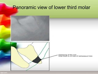 object Localization in intraoral radiographies | PPTX
