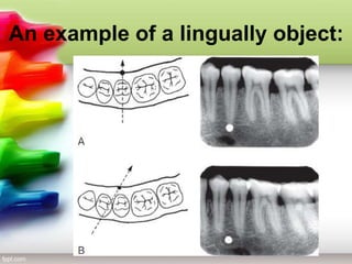 object Localization in intraoral radiographies | PPTX