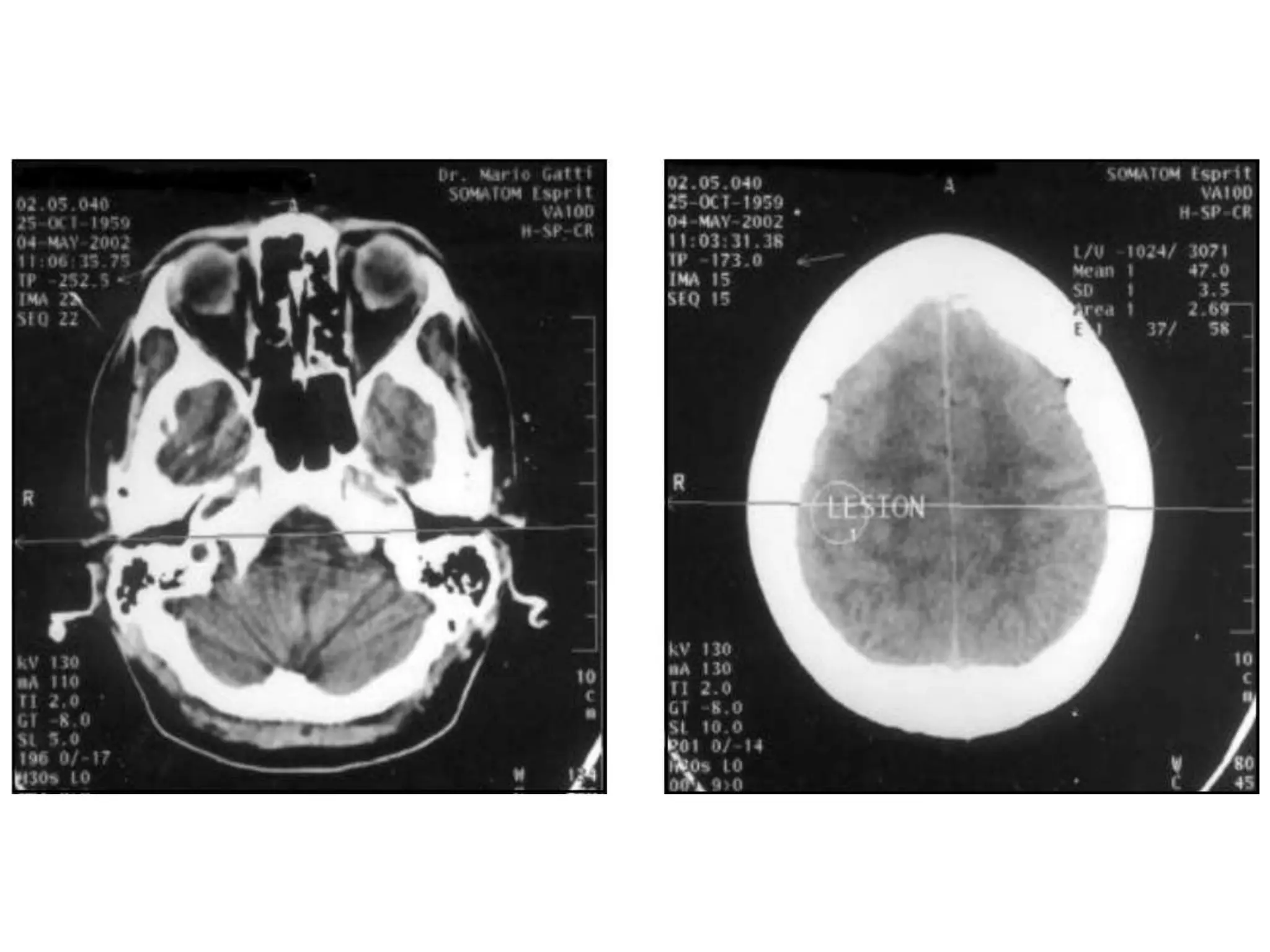 Localization of brain lesions | PPTX
