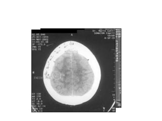 Localization of brain lesions | PPTX
