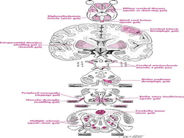 LOCALIZATION OFCENTRAL NERVOUS SYSTEM LESIONS | PPT