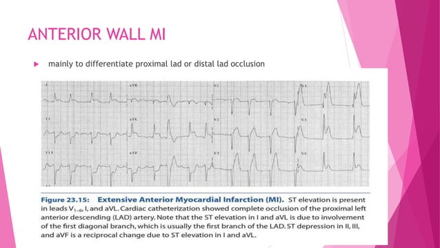 LOCALIZATION OF CULPRIT ARTERY IN MI.pptx