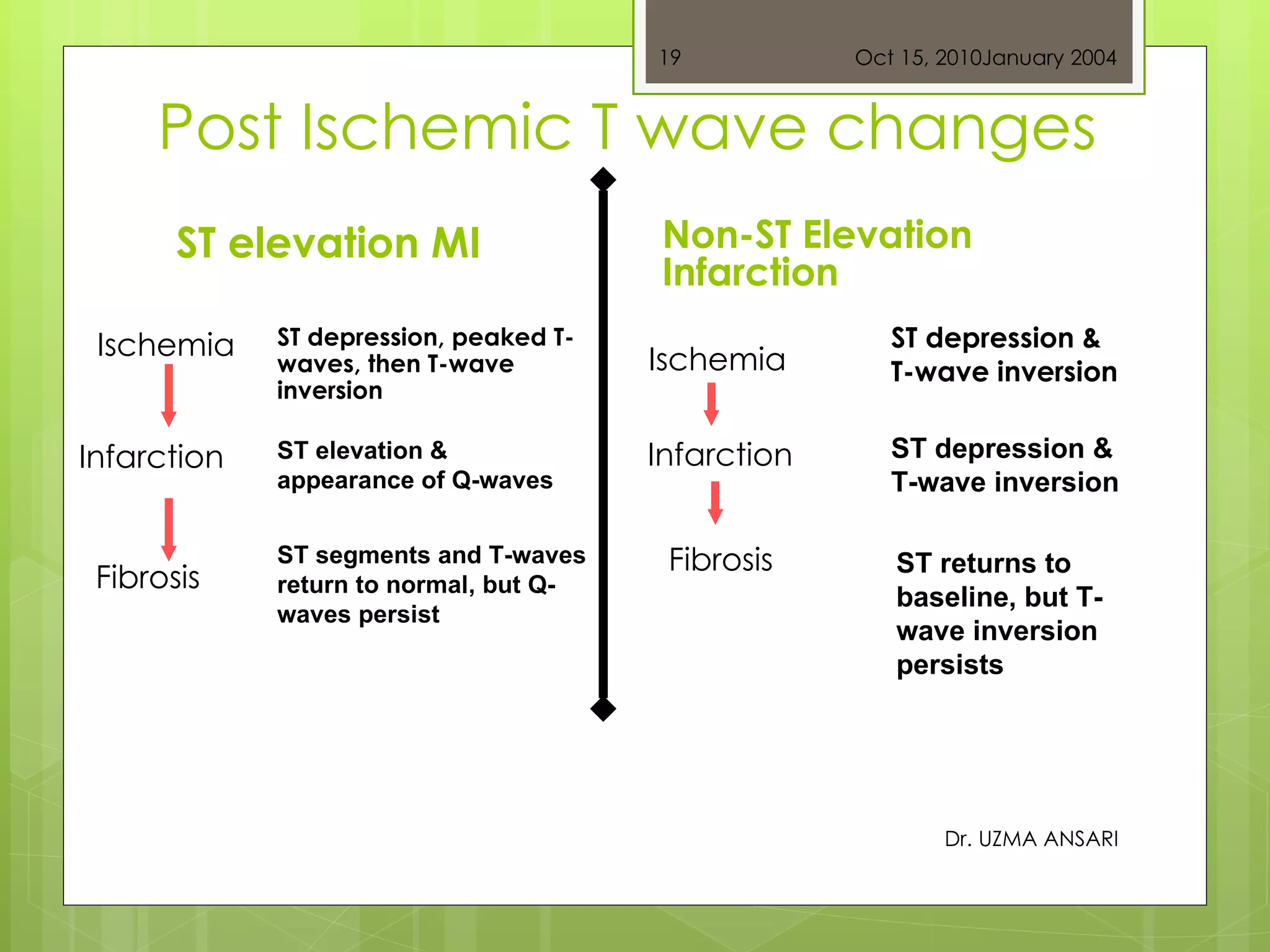 Localization of MI on ECG | PPT