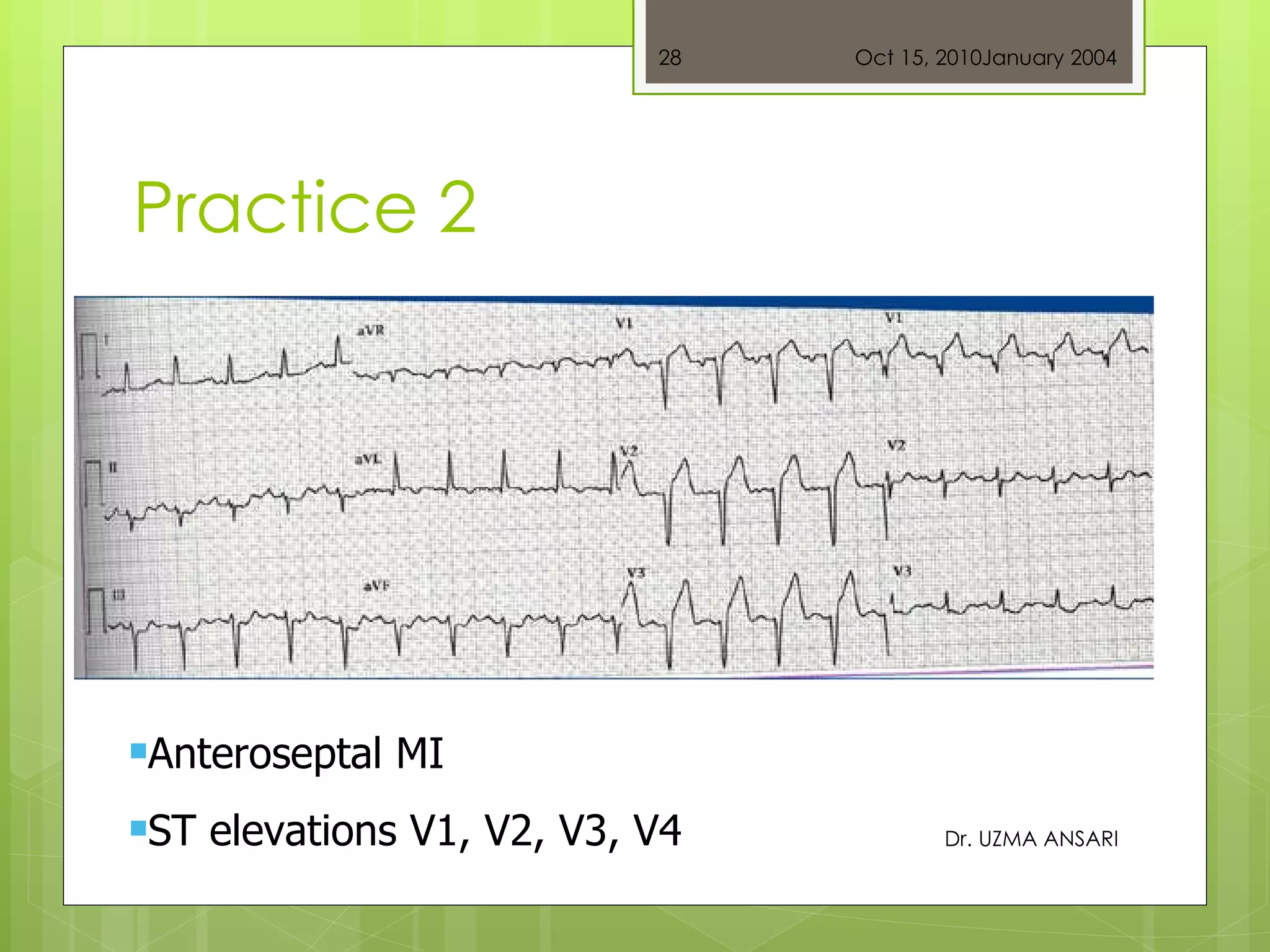 Localization of MI on ECG | PPT