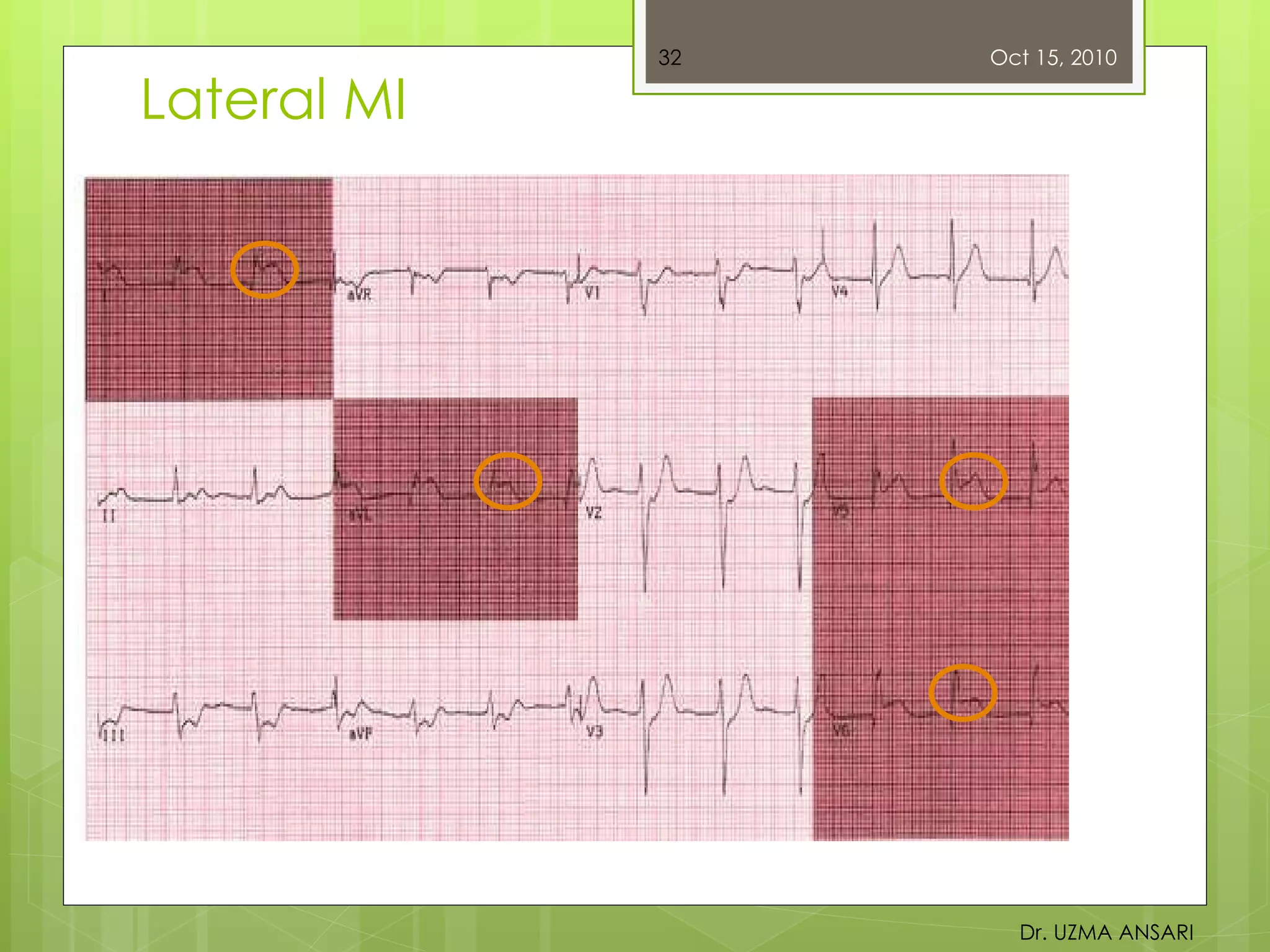 Localization of MI on ECG | PPT