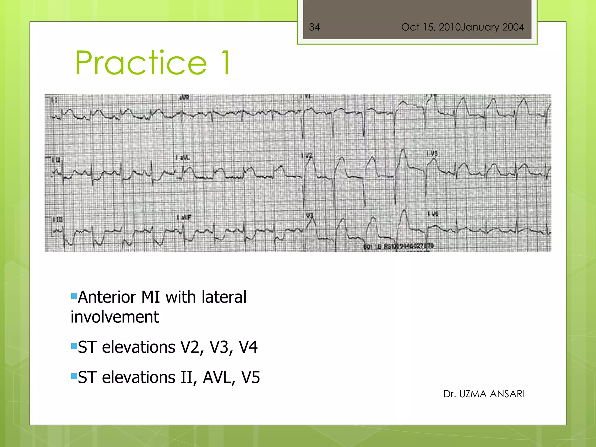 Localization of MI on ECG | PPT