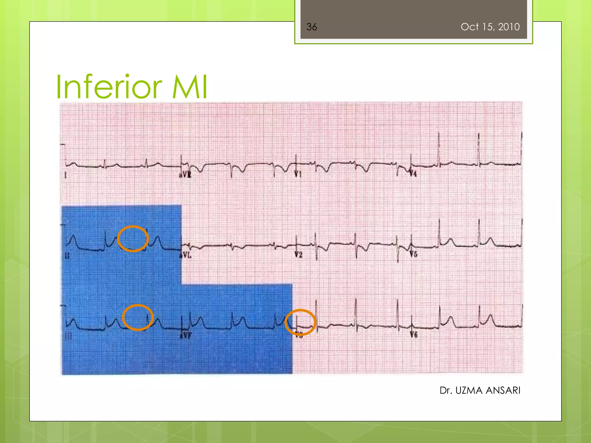 Localization of MI on ECG | PPT