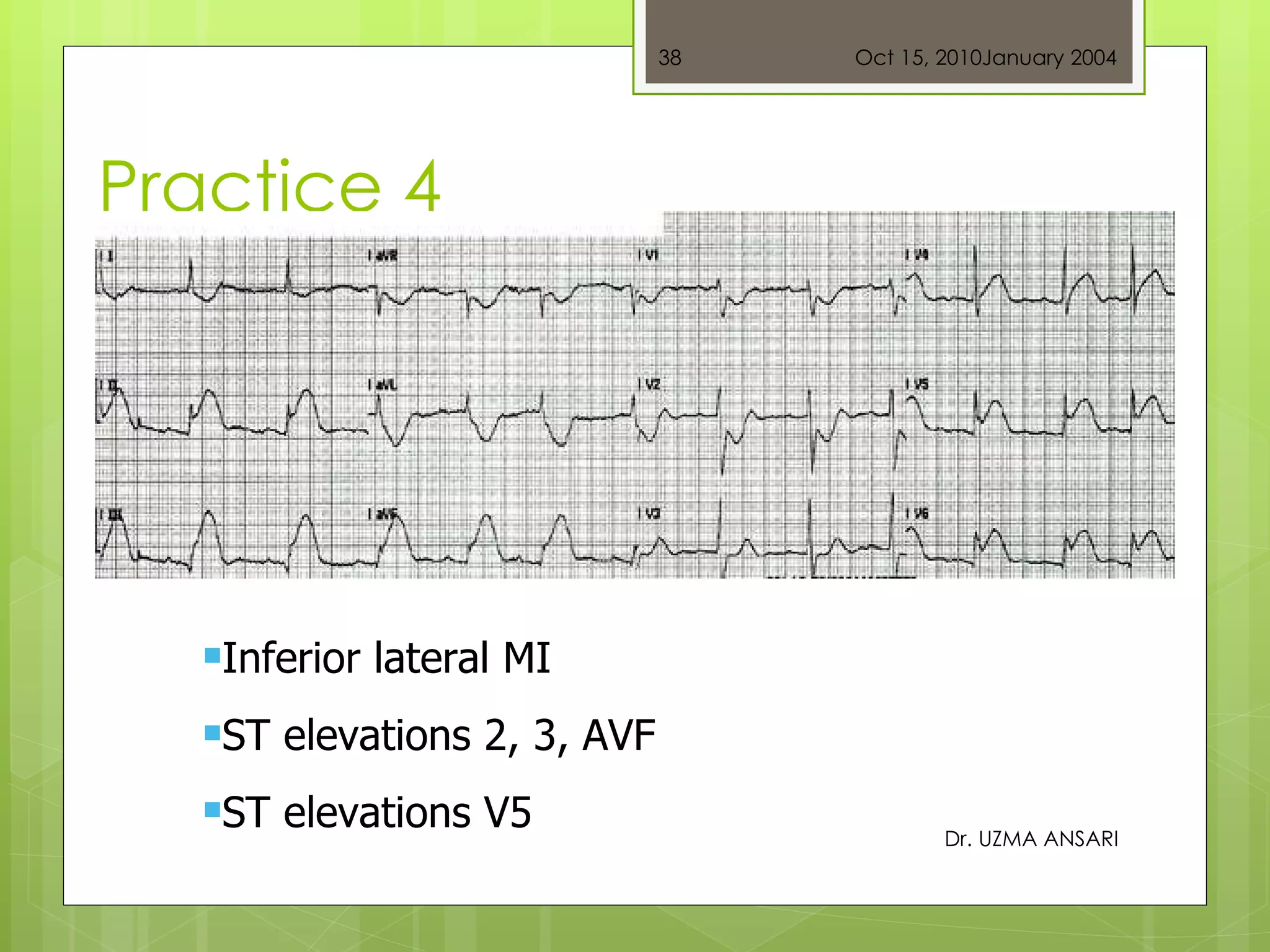 Localization of MI on ECG | PPT