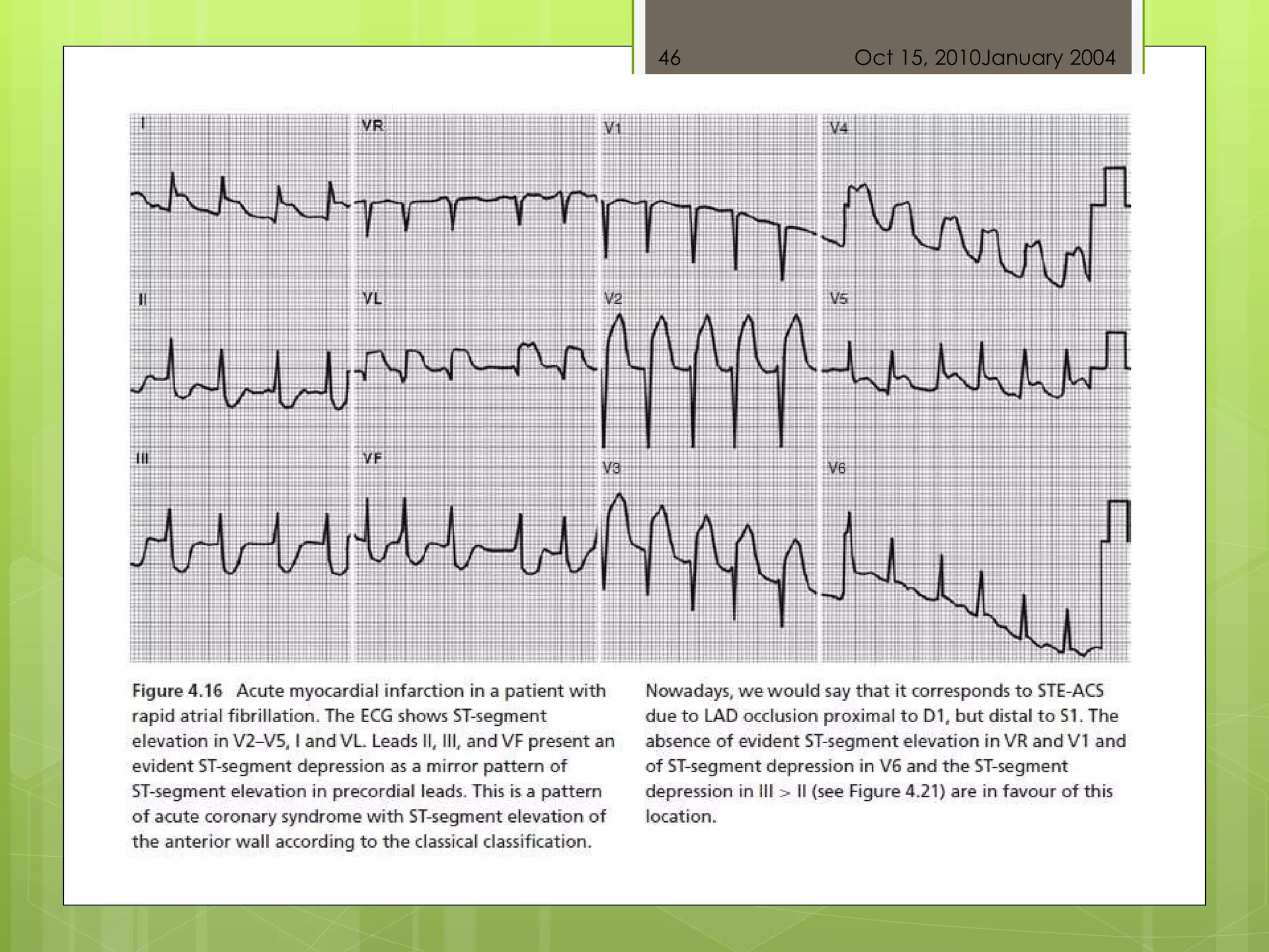 Localization of MI on ECG | PPT