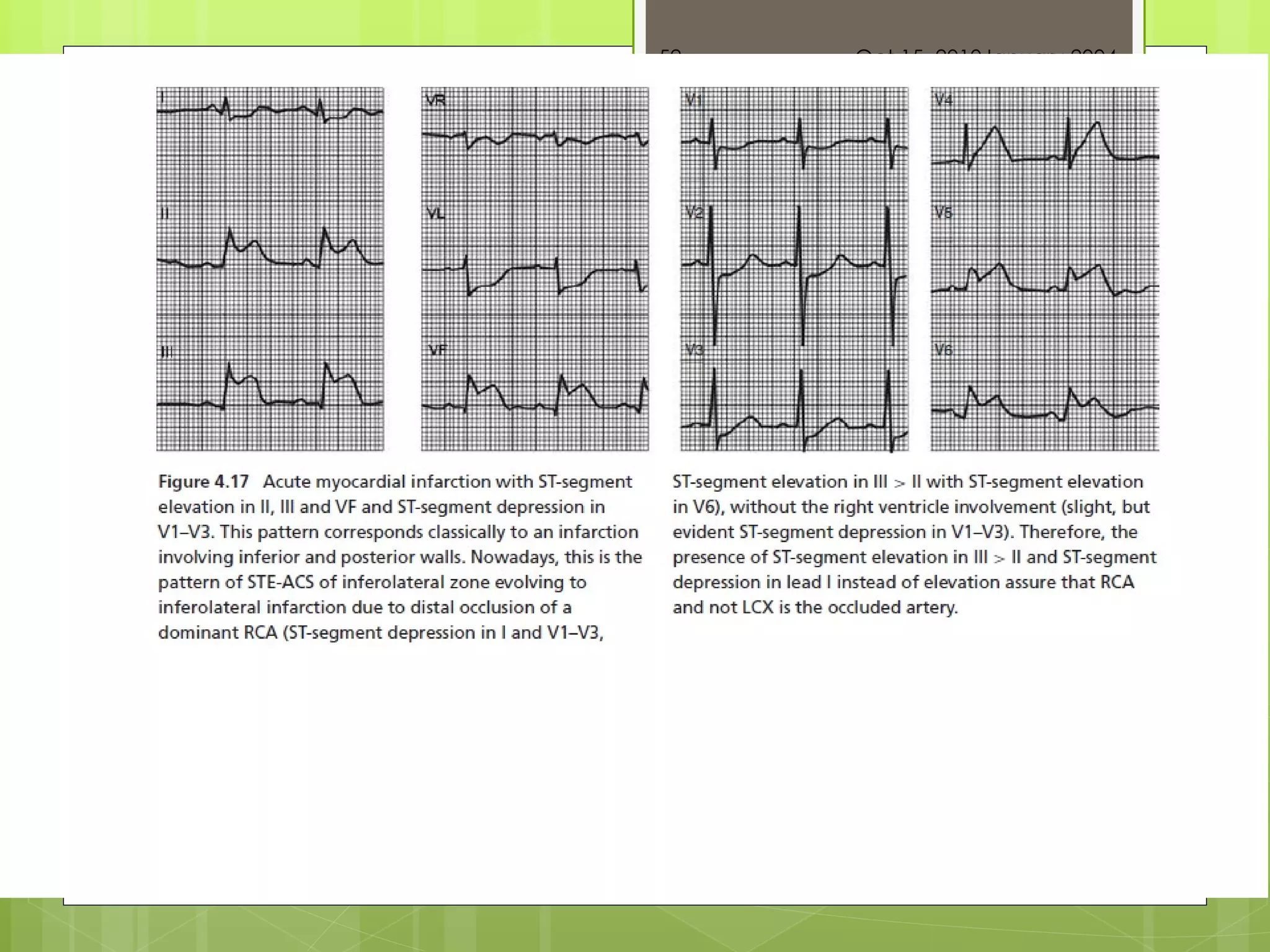 Localization of MI on ECG | PPT