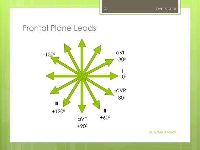 Localization of MI on ECG | PPT | Heart and Cardiovascular Diseases ...