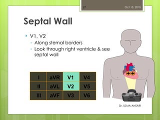 Localization of MI on ECG | PPT