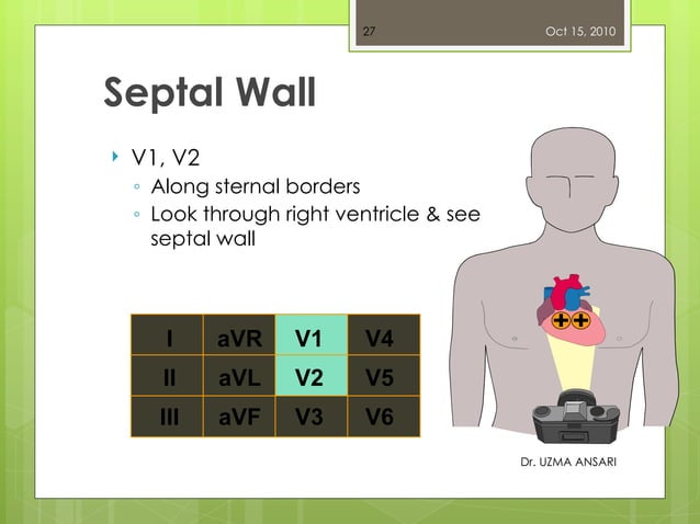 Localization of MI on ECG | PPT | Heart and Cardiovascular Diseases ...