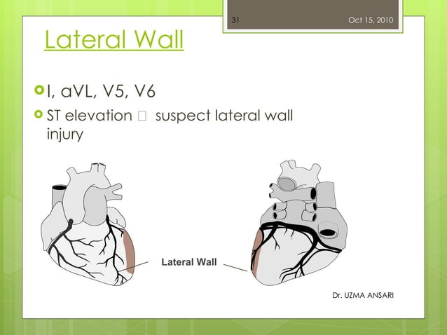 Localization of MI on ECG | PPT | Heart and Cardiovascular Diseases ...