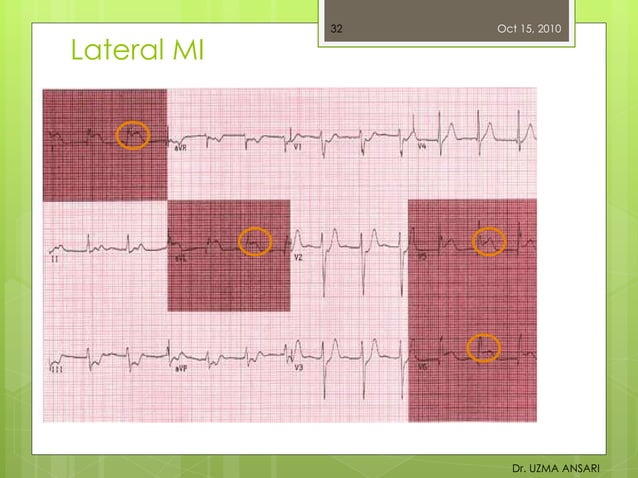Localization of MI on ECG | PPT | Heart and Cardiovascular Diseases ...
