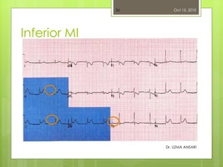 Localization of MI on ECG | PPT