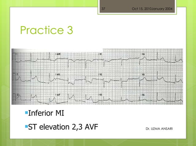 Localization of MI on ECG | PPT | Heart and Cardiovascular Diseases ...
