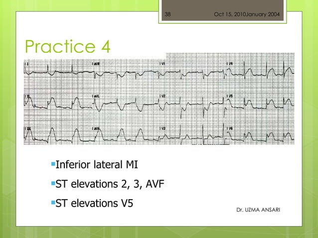 Localization of MI on ECG | PPT | Heart and Cardiovascular Diseases ...