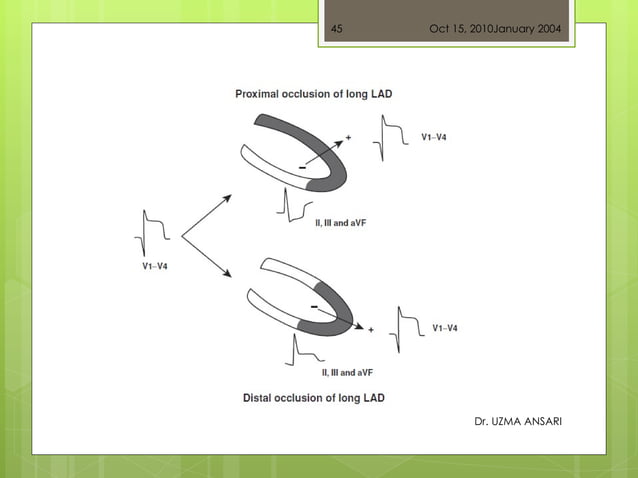 Localization of MI on ECG | PPT | Heart and Cardiovascular Diseases ...