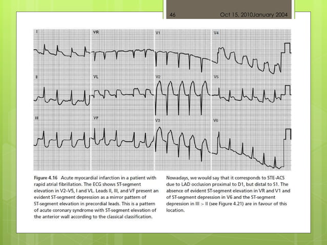 Localization of MI on ECG | PPT | Heart and Cardiovascular Diseases ...